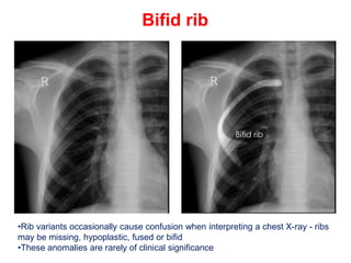 CHESTX-RAY ANATOMICAL VARIANTS......pptx