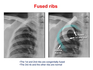 CHESTX-RAY ANATOMICAL VARIANTS......pptx