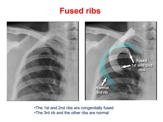 CHESTX-RAY ANATOMICAL VARIANTS......pptx