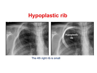 CHESTX-RAY ANATOMICAL VARIANTS......pptx