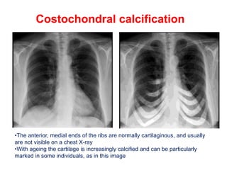 CHESTX-RAY ANATOMICAL VARIANTS......pptx