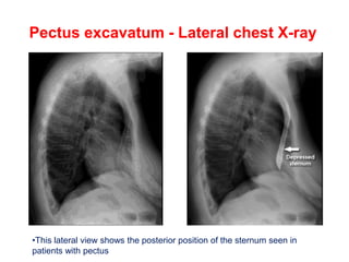 CHESTX-RAY ANATOMICAL VARIANTS......pptx