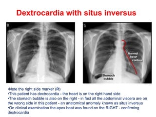 CHESTX-RAY ANATOMICAL VARIANTS......pptx