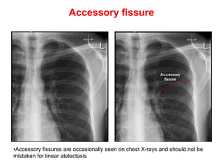 CHESTX-RAY ANATOMICAL VARIANTS......pptx