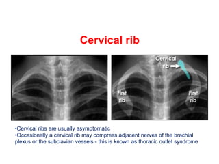 CHESTX-RAY ANATOMICAL VARIANTS......pptx