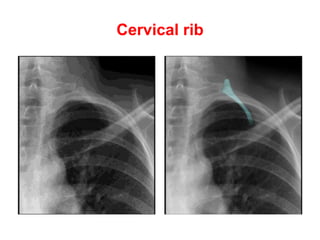 CHESTX-RAY ANATOMICAL VARIANTS......pptx