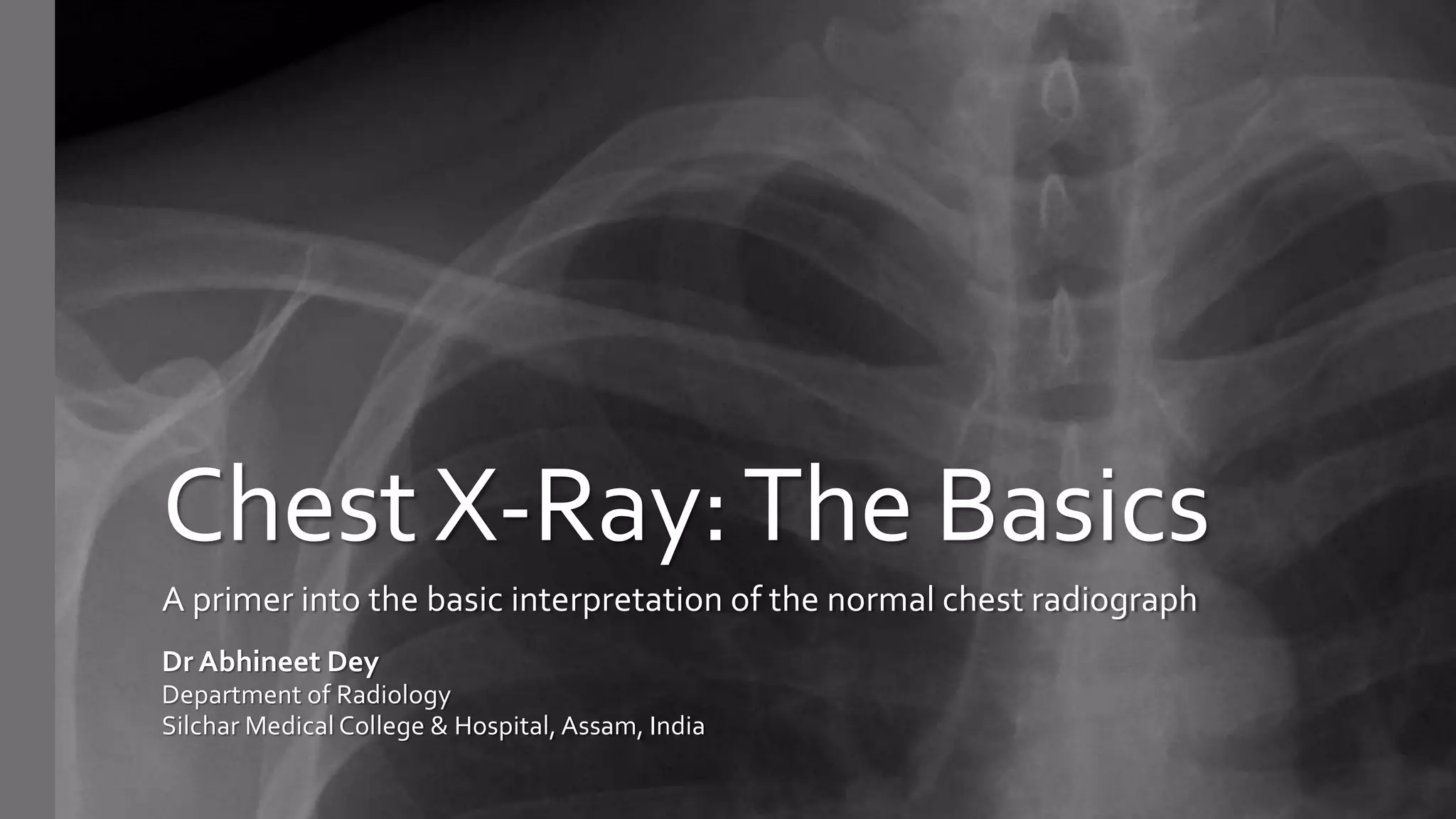 Chest X-ray: The Basics | PPTX