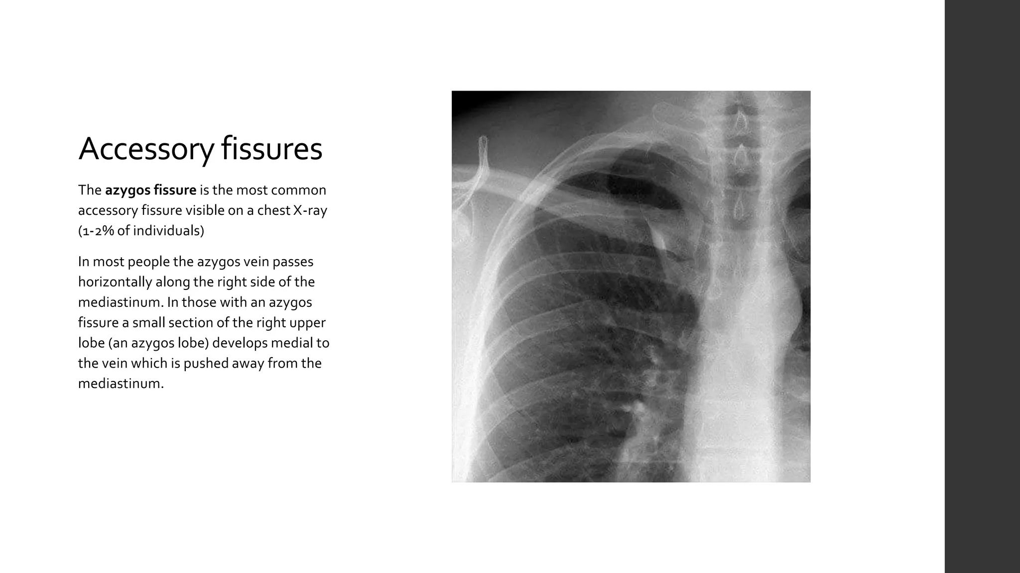 Chest X-ray: The Basics | PPTX