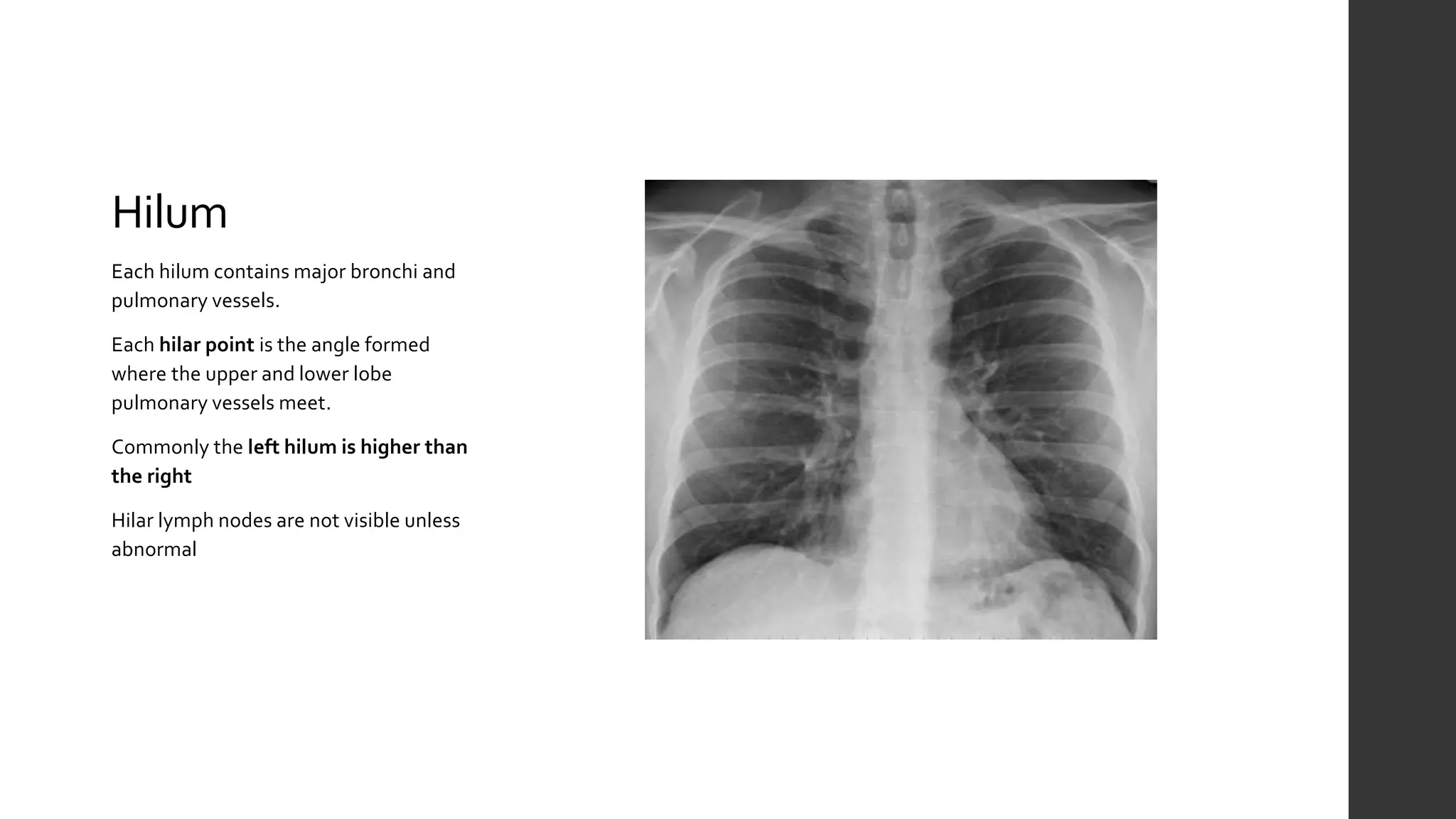 Chest X-ray: The Basics | PPTX