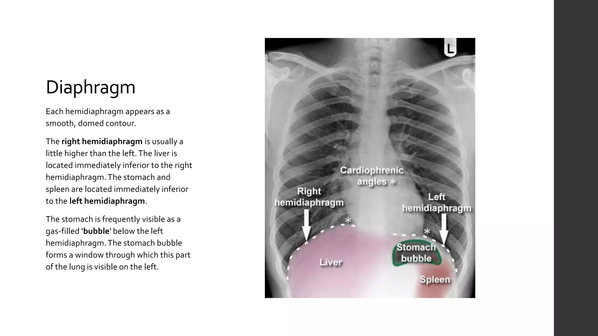Chest X-ray: The Basics | PPTX