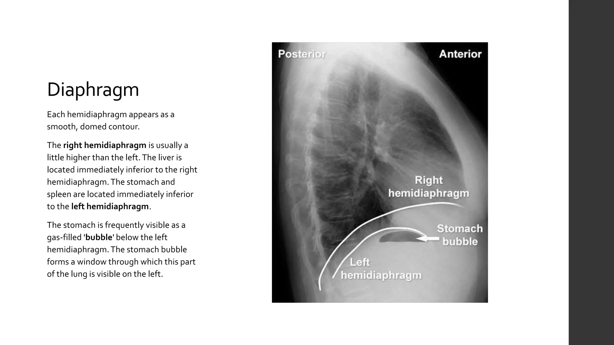 Chest X-ray: The Basics | PPTX