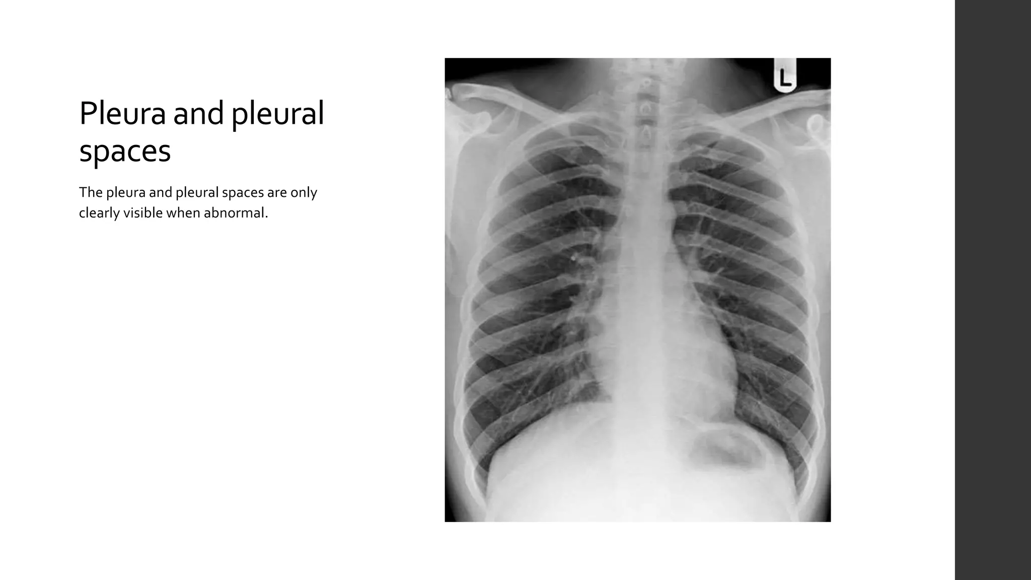 Chest X-ray: The Basics | PPTX