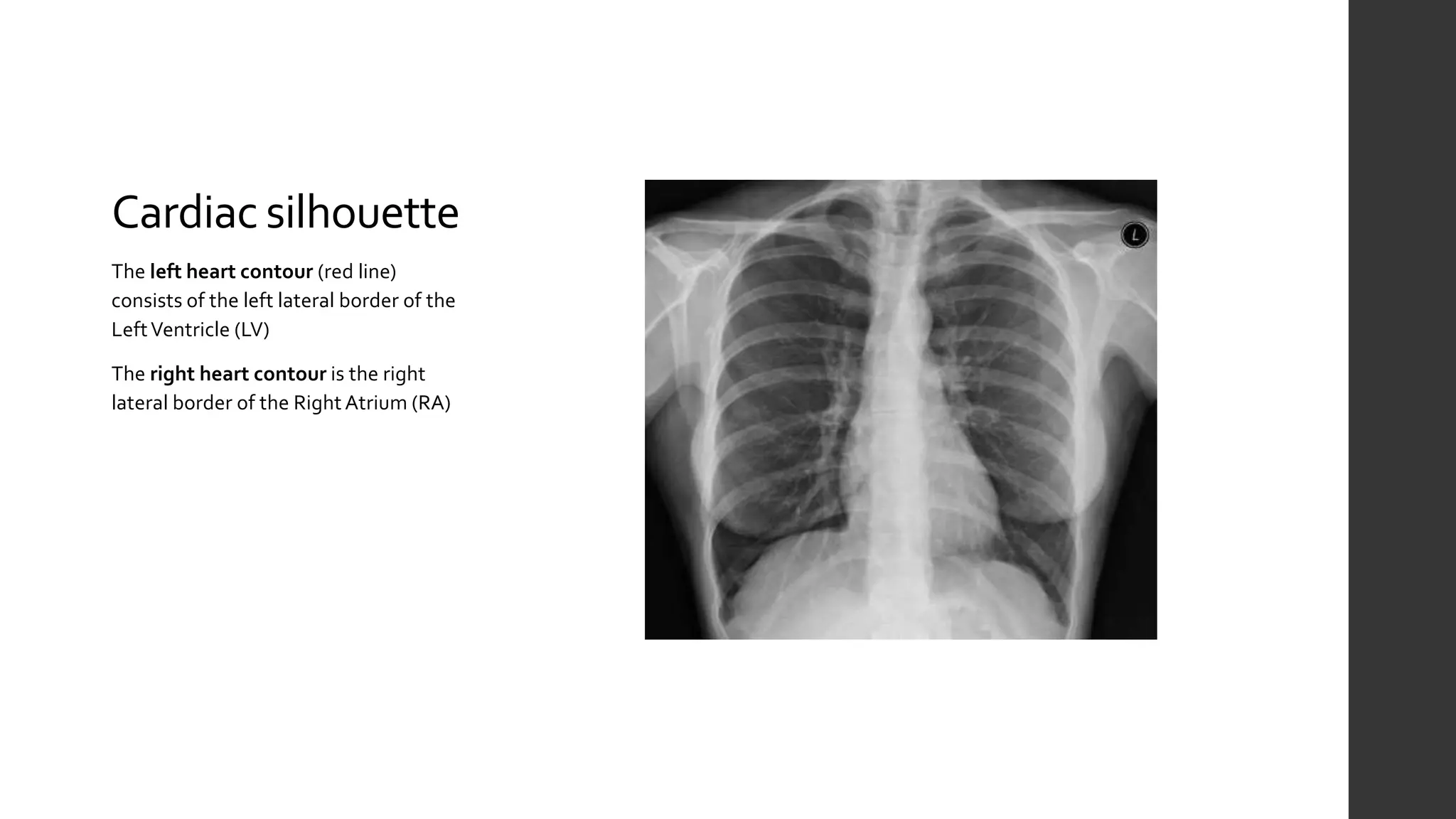 Chest X-ray: The Basics | PPTX
