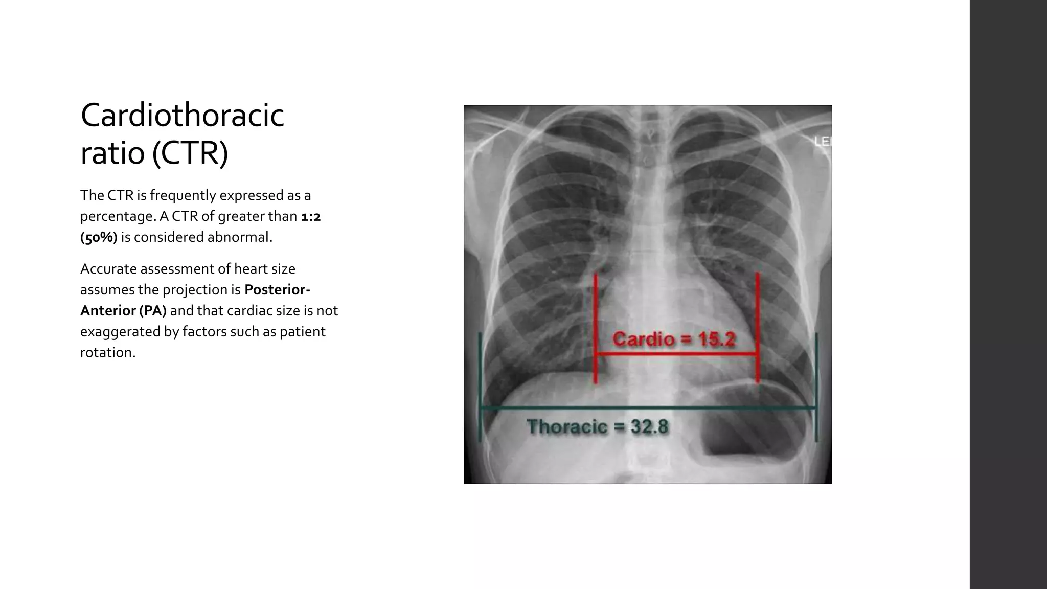 Chest X-ray: The Basics | PPTX