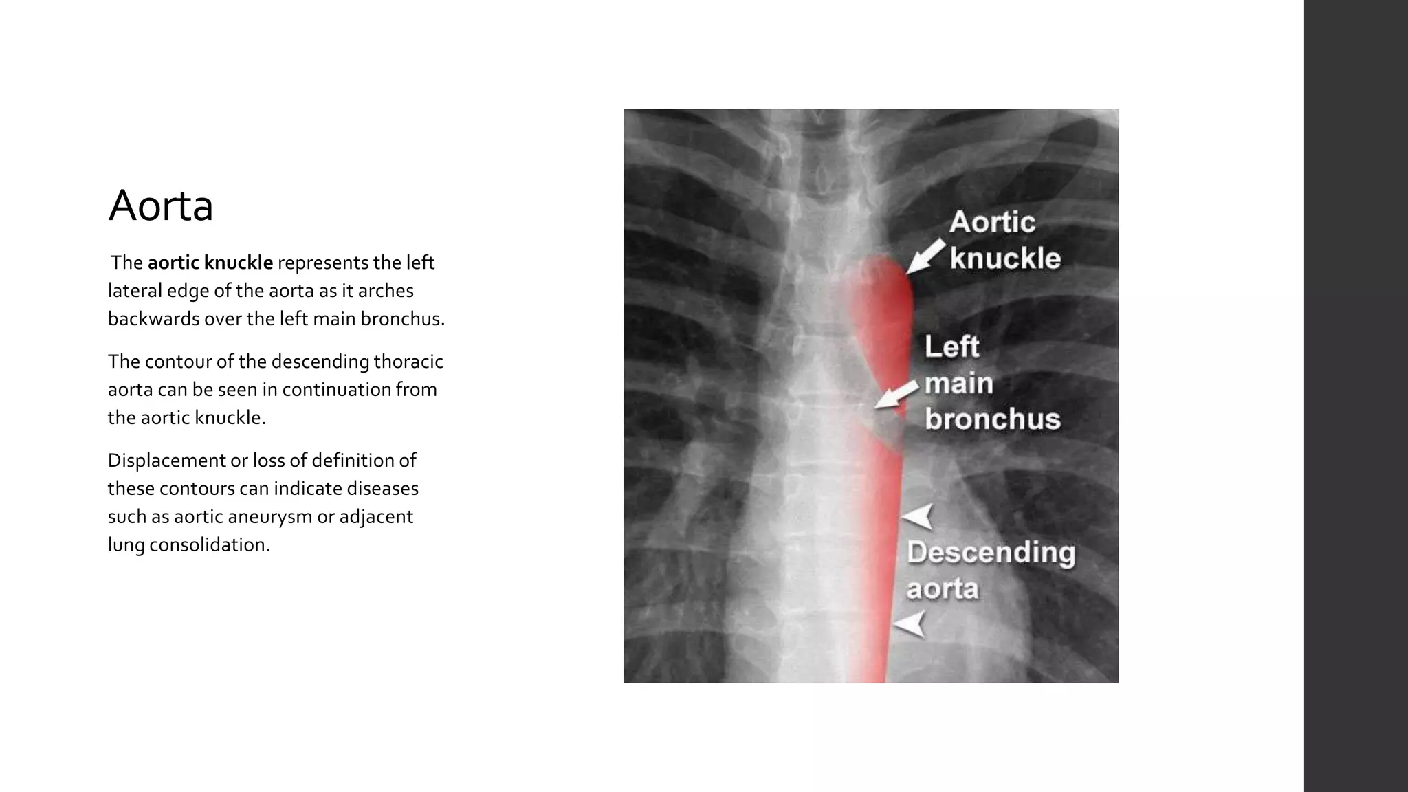 Chest X-ray: The Basics | PPTX