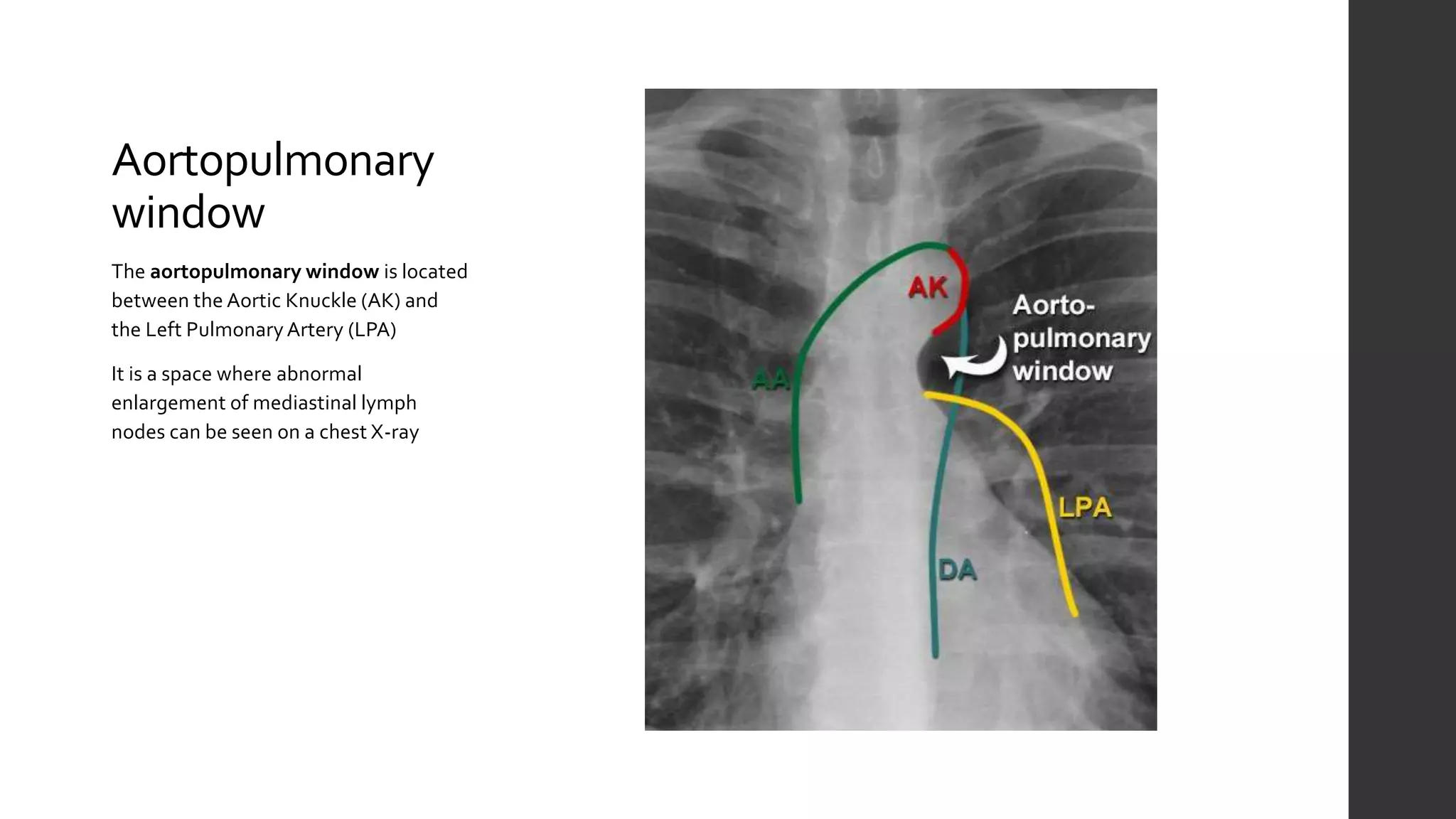 Chest X-ray: The Basics | PPTX