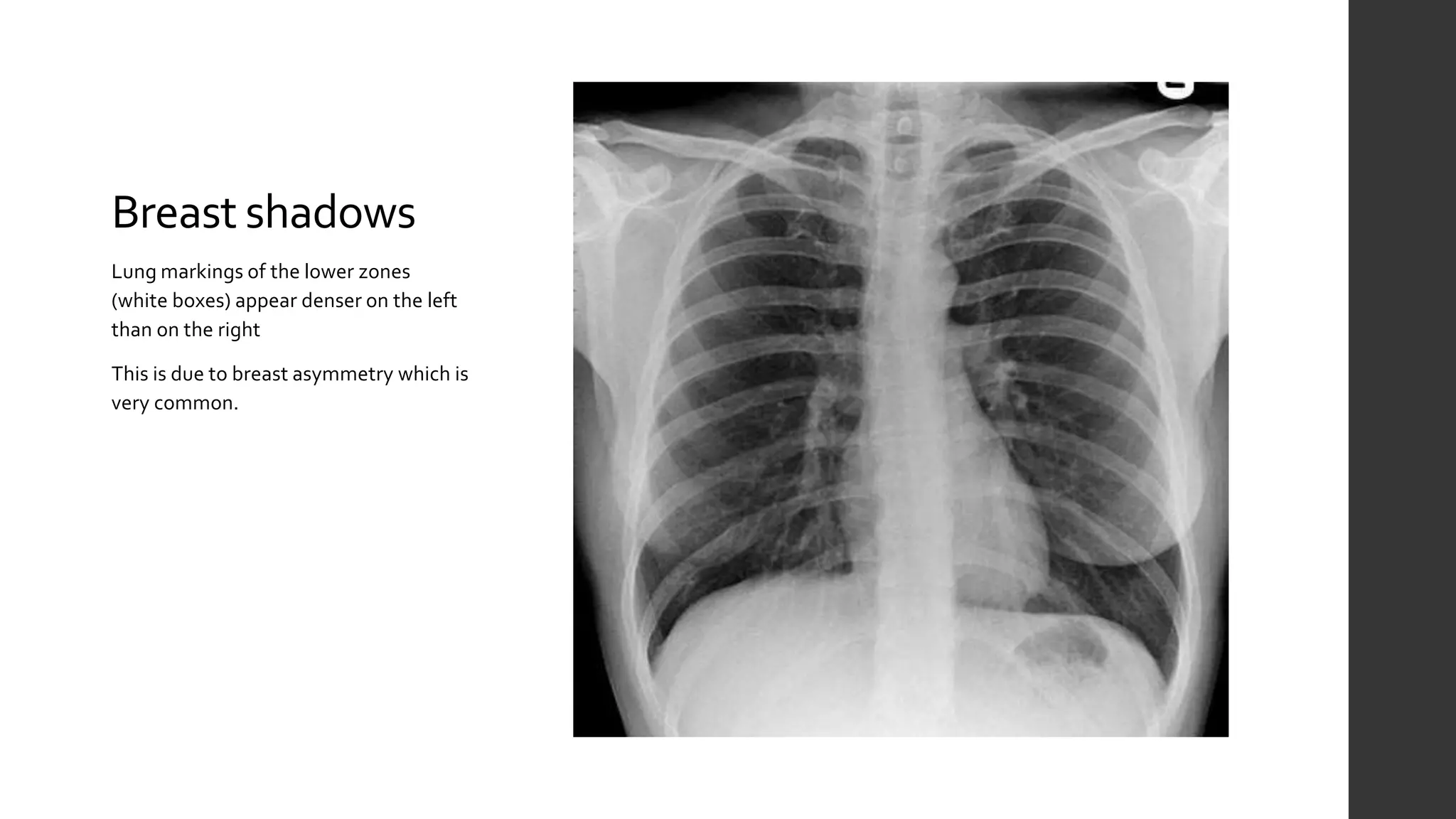 Chest X-ray: The Basics | PPTX