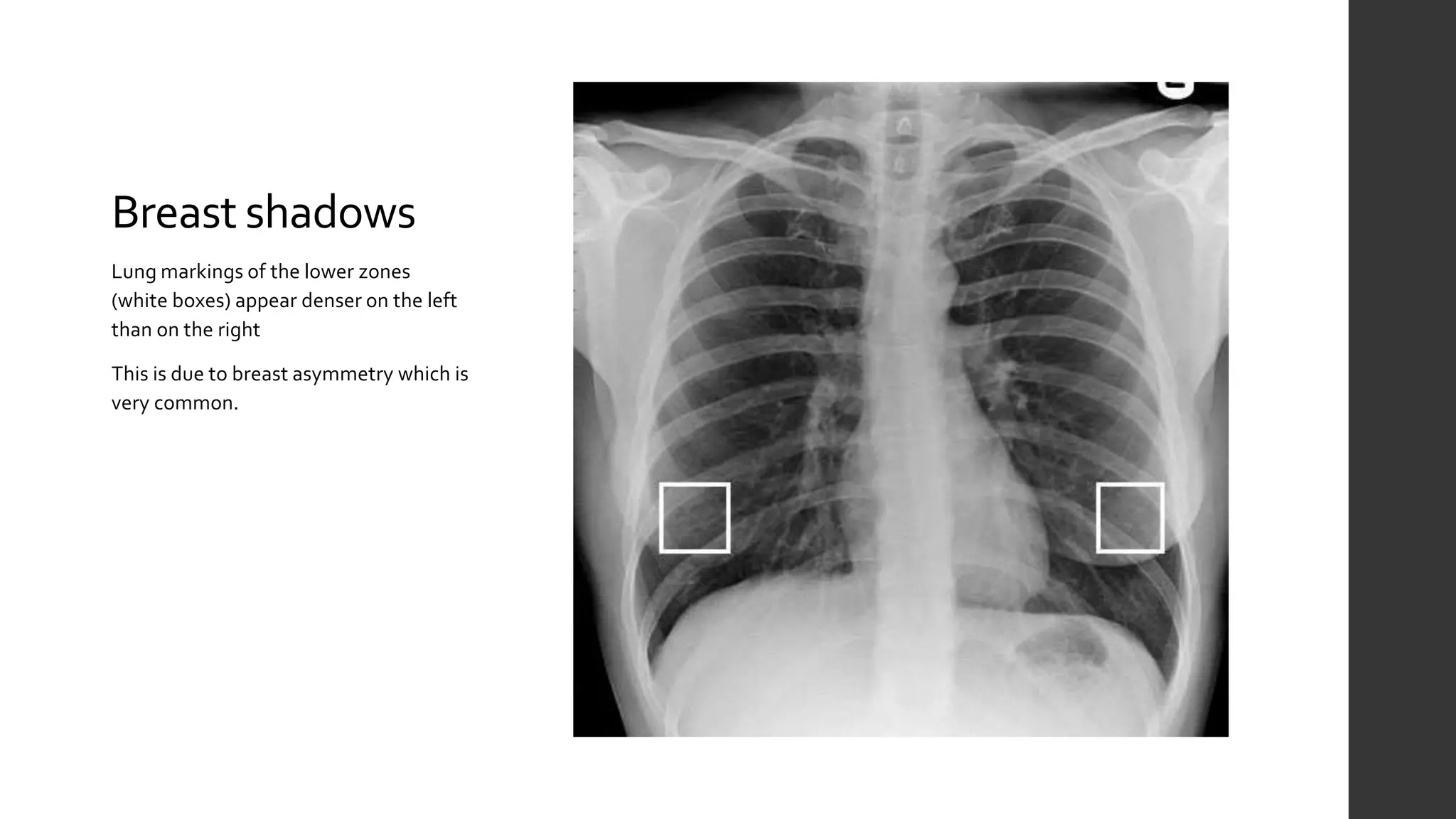 Chest X-ray: The Basics | PPTX