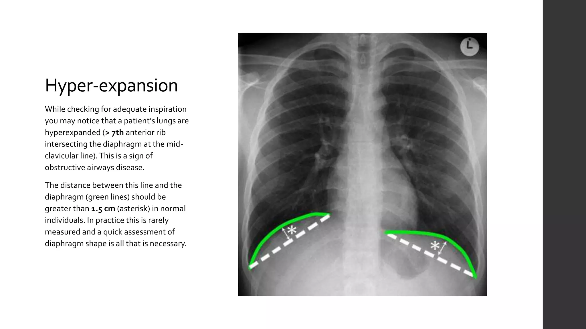 Chest X-ray: The Basics | PPTX