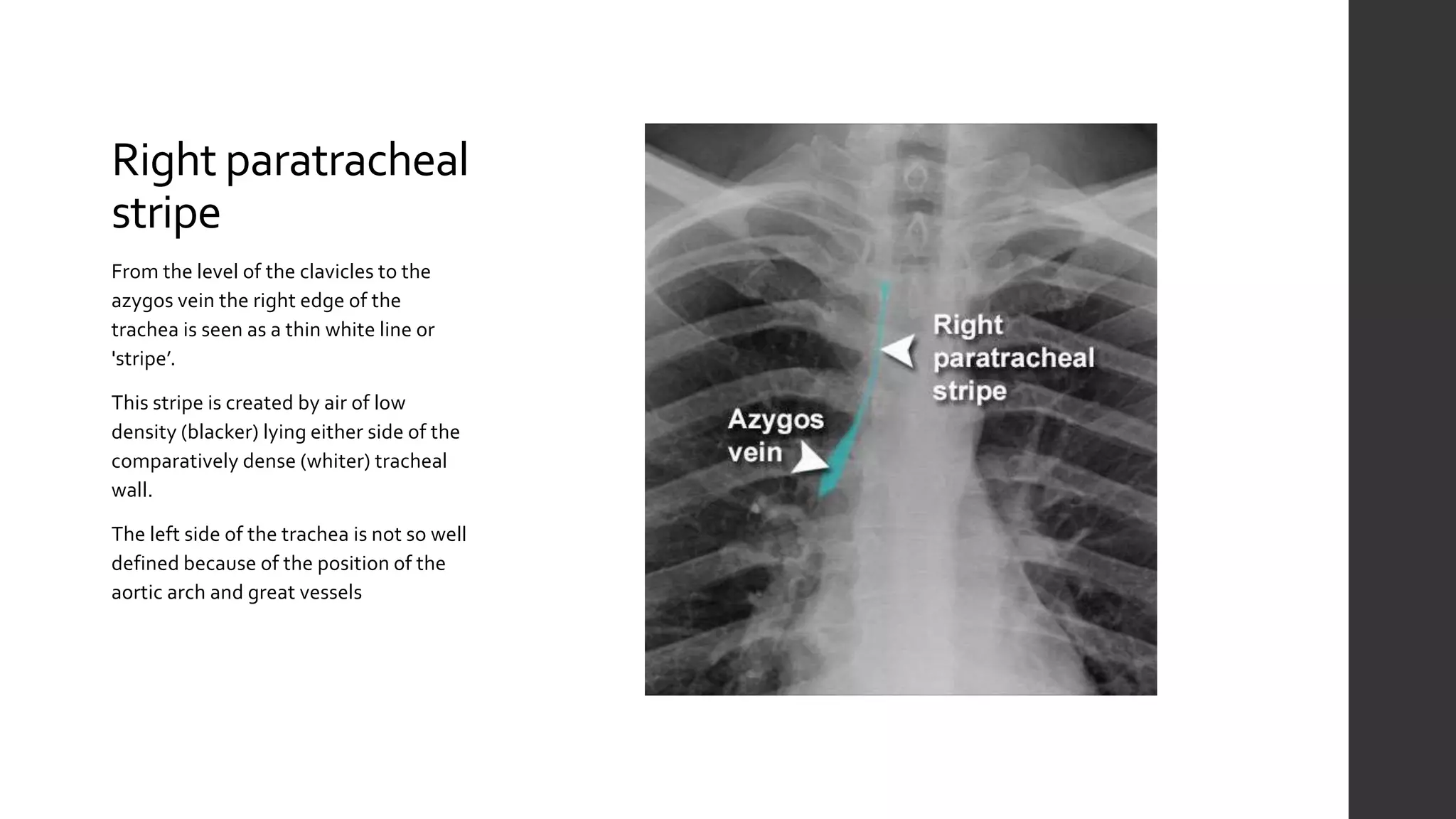 Chest X-ray: The Basics | PPTX