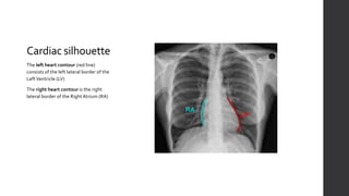 Chest X-ray: The Basics | PPTX