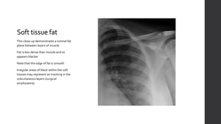 Chest X-ray: The Basics | PPTX