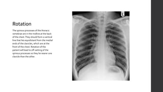 Chest X-ray: The Basics | PPTX