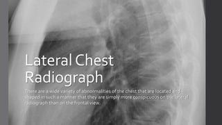 Chest X-ray: The Basics | PPTX