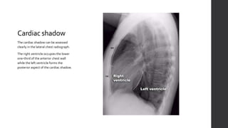 Chest X-ray: The Basics | PPTX