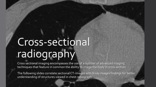 Chest X-ray: The Basics | PPTX