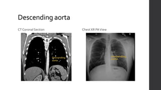 Chest X-ray: The Basics | PPTX
