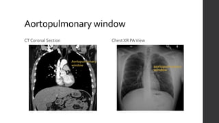 Chest X-ray: The Basics | PPTX