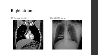 Chest X-ray: The Basics | PPTX