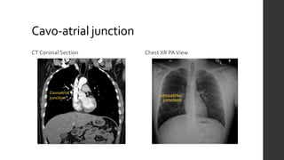 Chest X-ray: The Basics | PPTX