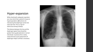 Chest X-ray: The Basics | PPT