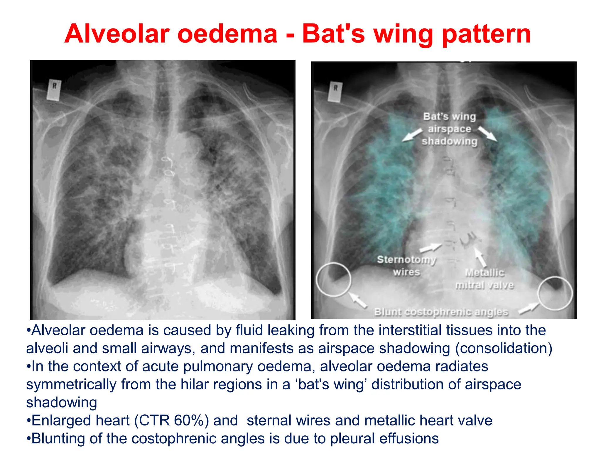 CHEST X-RAY CARDIAC DISEASE.........pptx