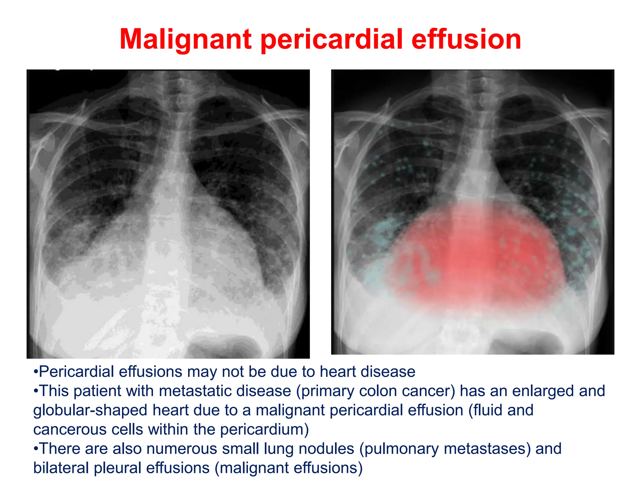 CHEST X-RAY CARDIAC DISEASE.........pptx