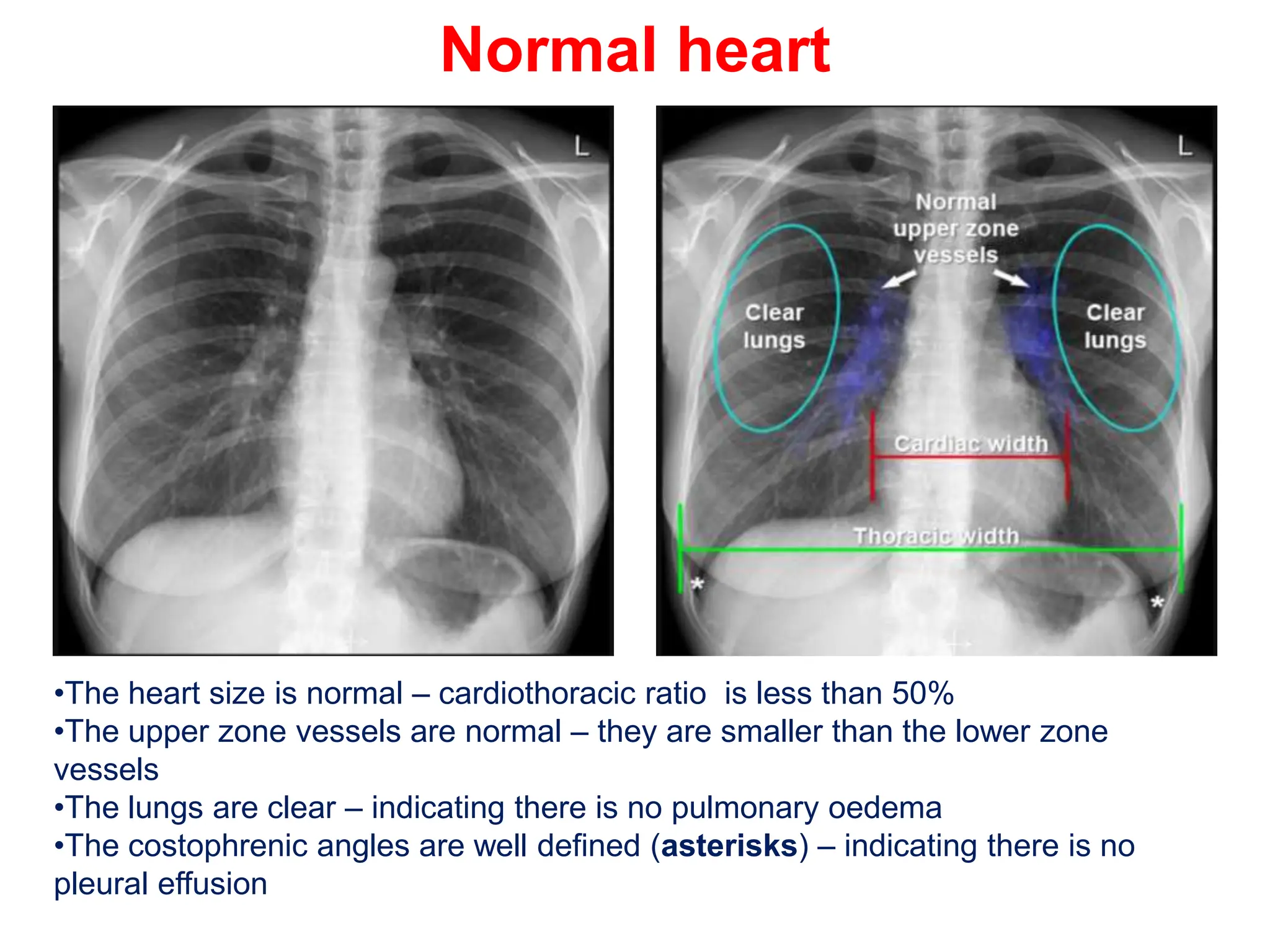 CHEST X-RAY CARDIAC DISEASE.........pptx