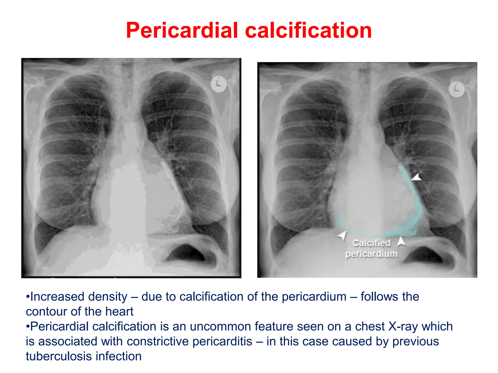 CHEST X-RAY CARDIAC DISEASE.........pptx