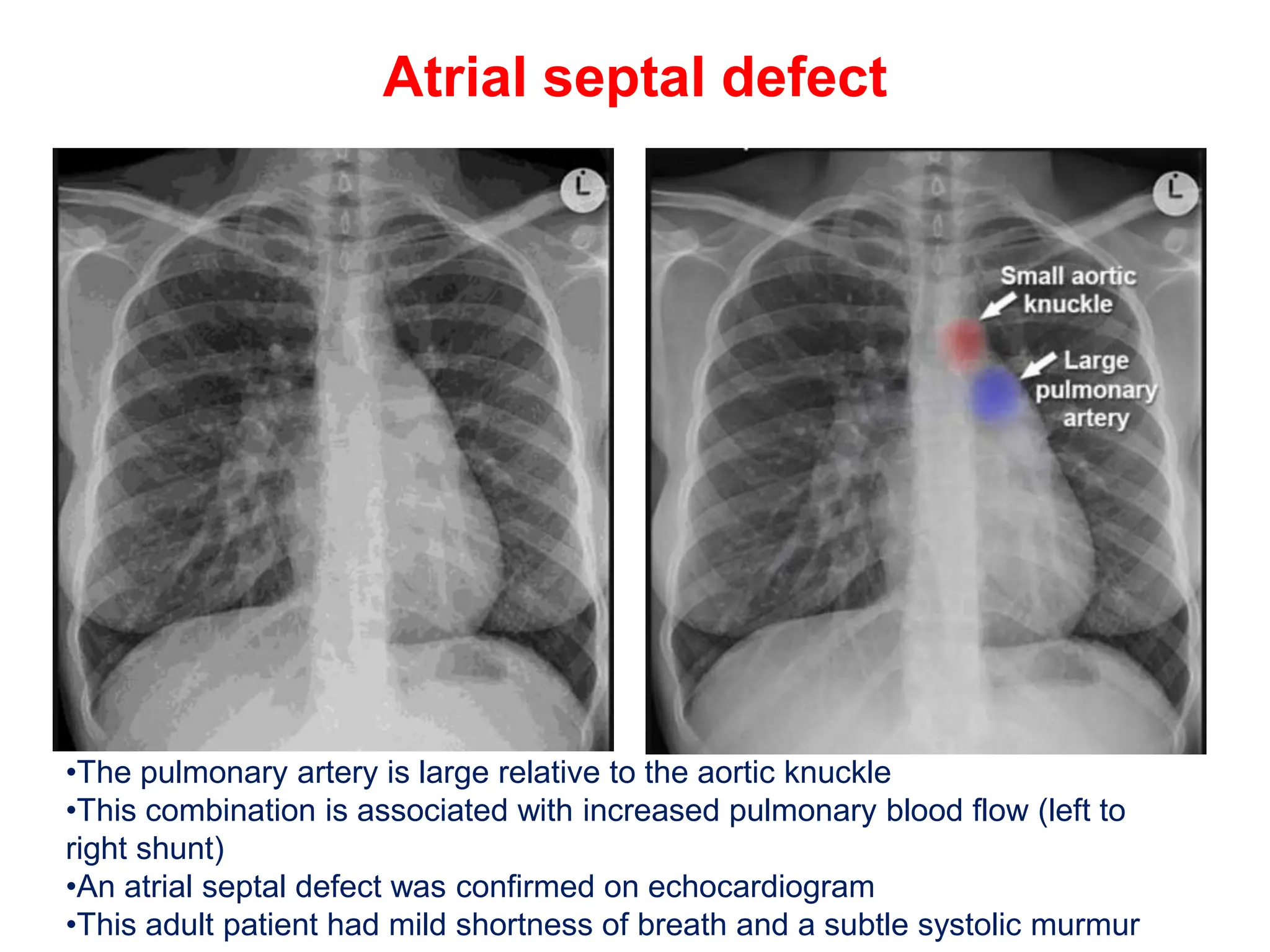 CHEST X-RAY CARDIAC DISEASE.........pptx