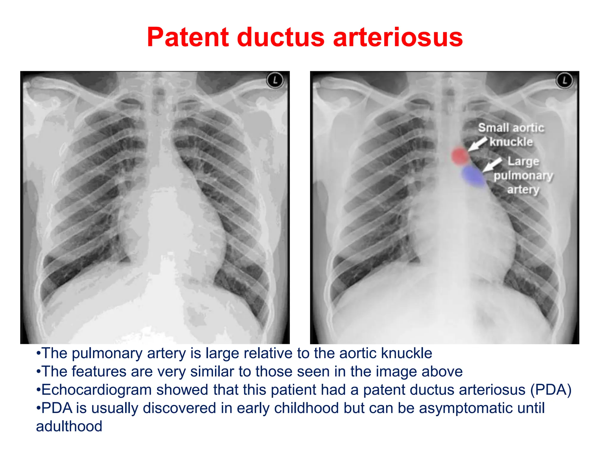 CHEST X-RAY CARDIAC DISEASE.........pptx