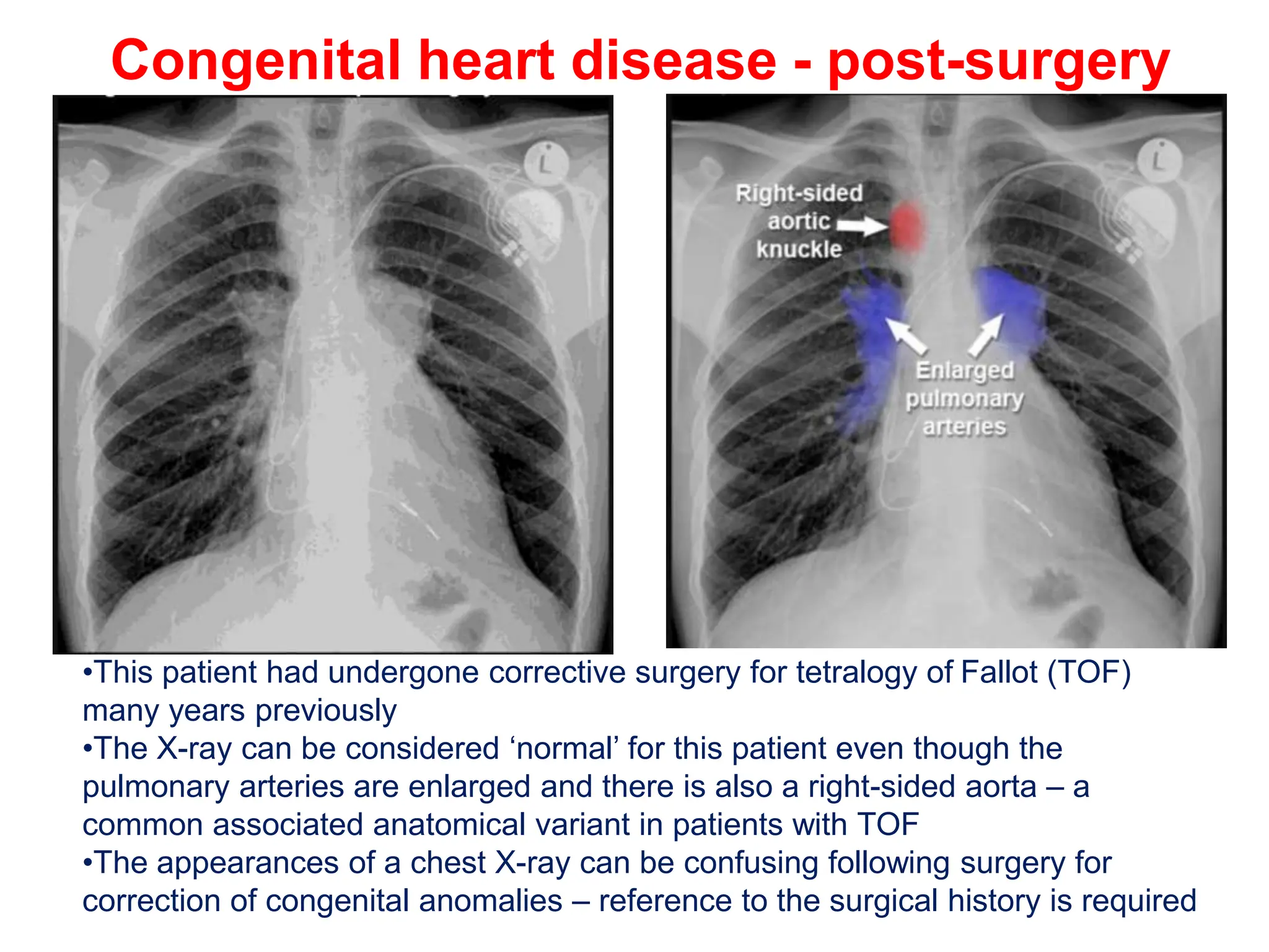 CHEST X-RAY CARDIAC DISEASE.........pptx