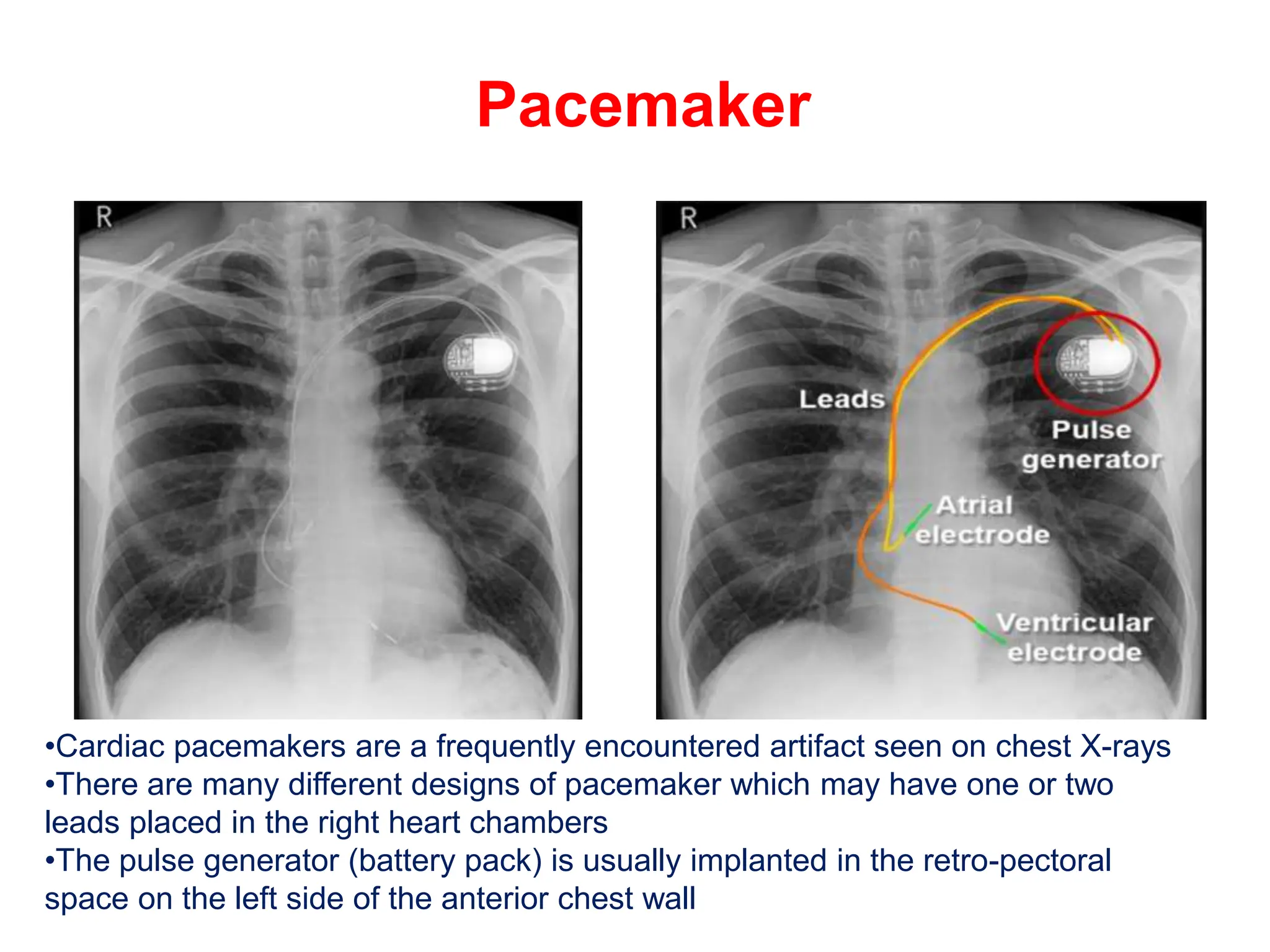 CHEST X-RAY CARDIAC DISEASE.........pptx