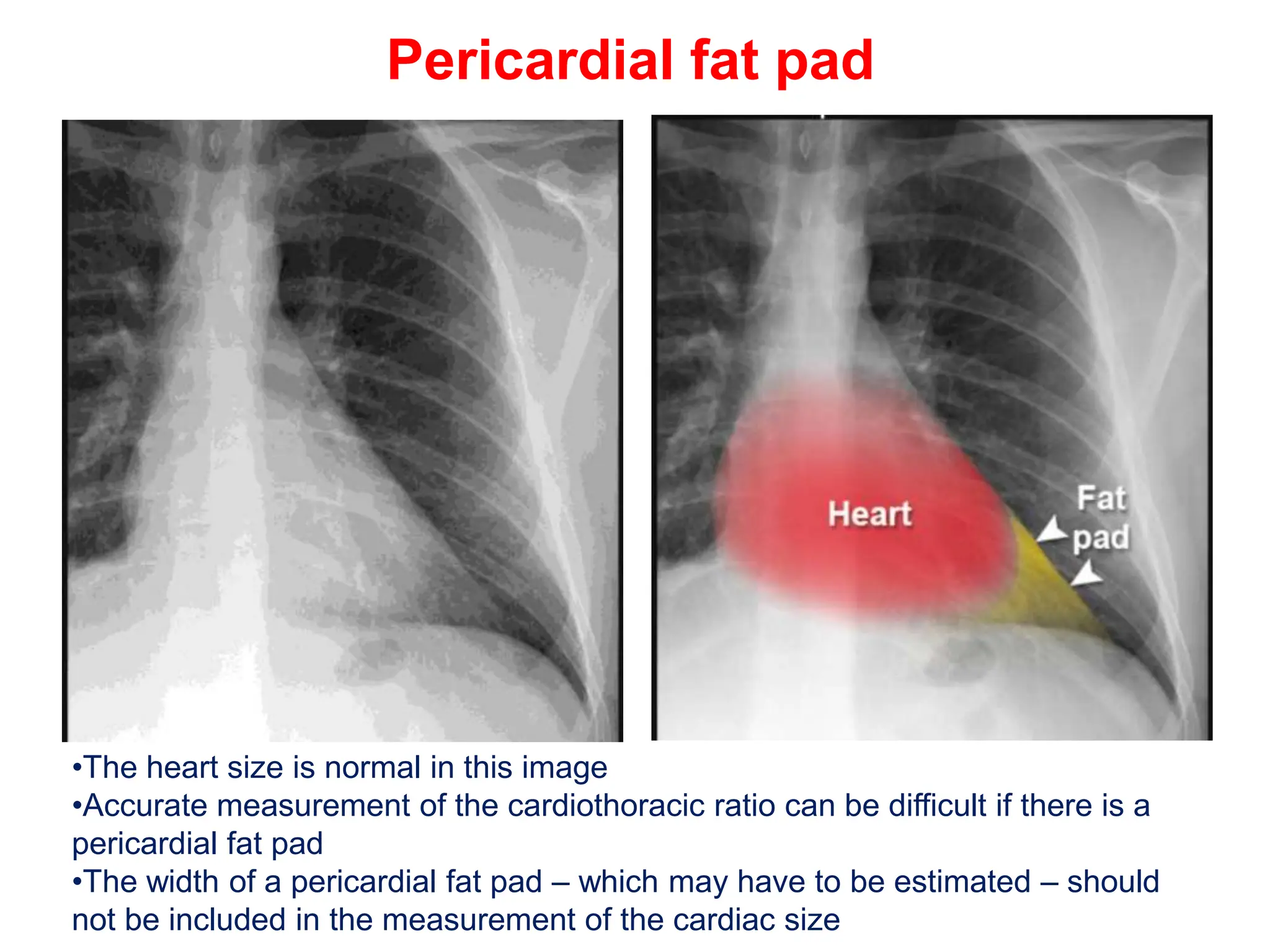 CHEST X-RAY CARDIAC DISEASE.........pptx