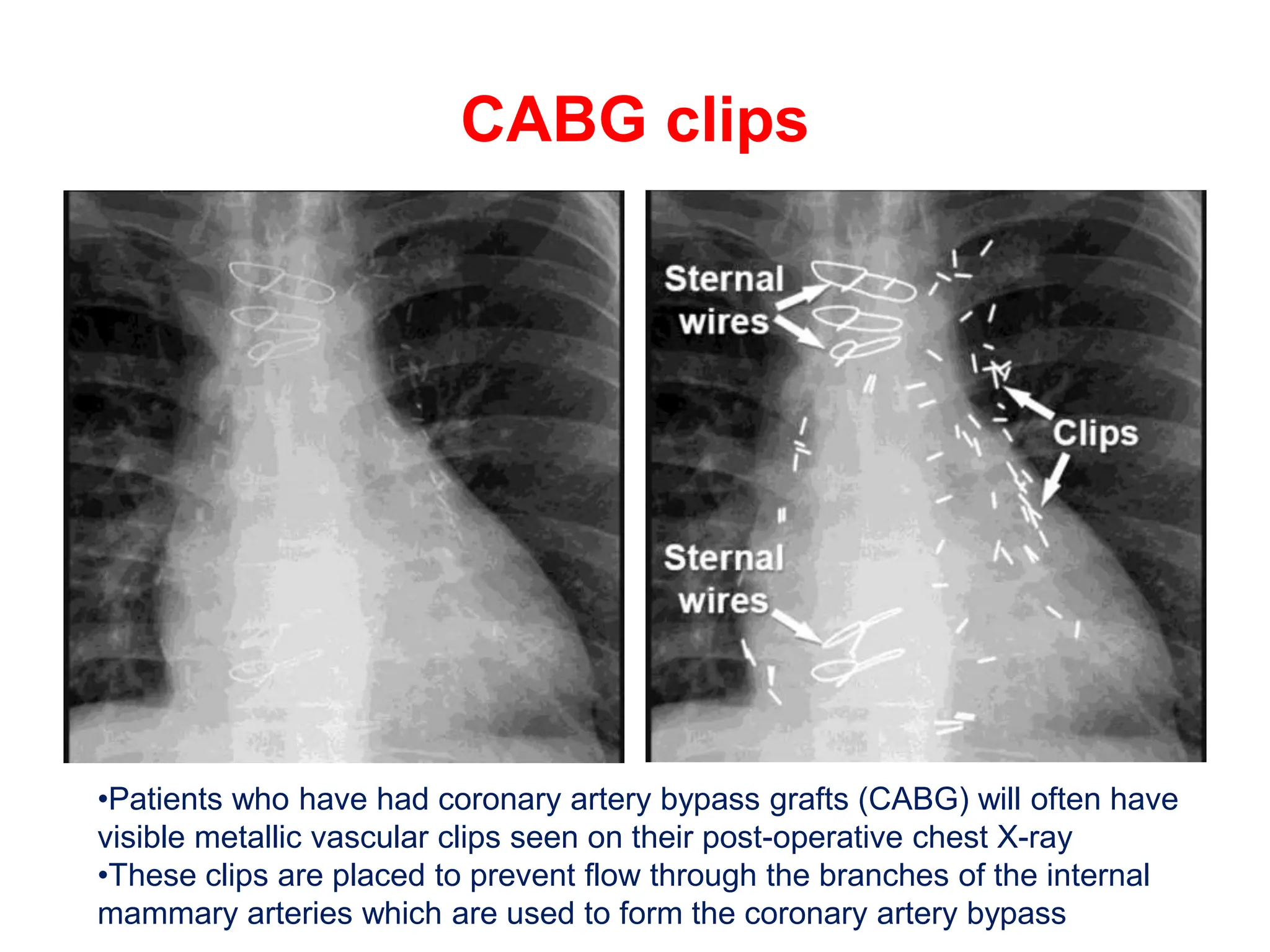 CHEST X-RAY CARDIAC DISEASE.........pptx