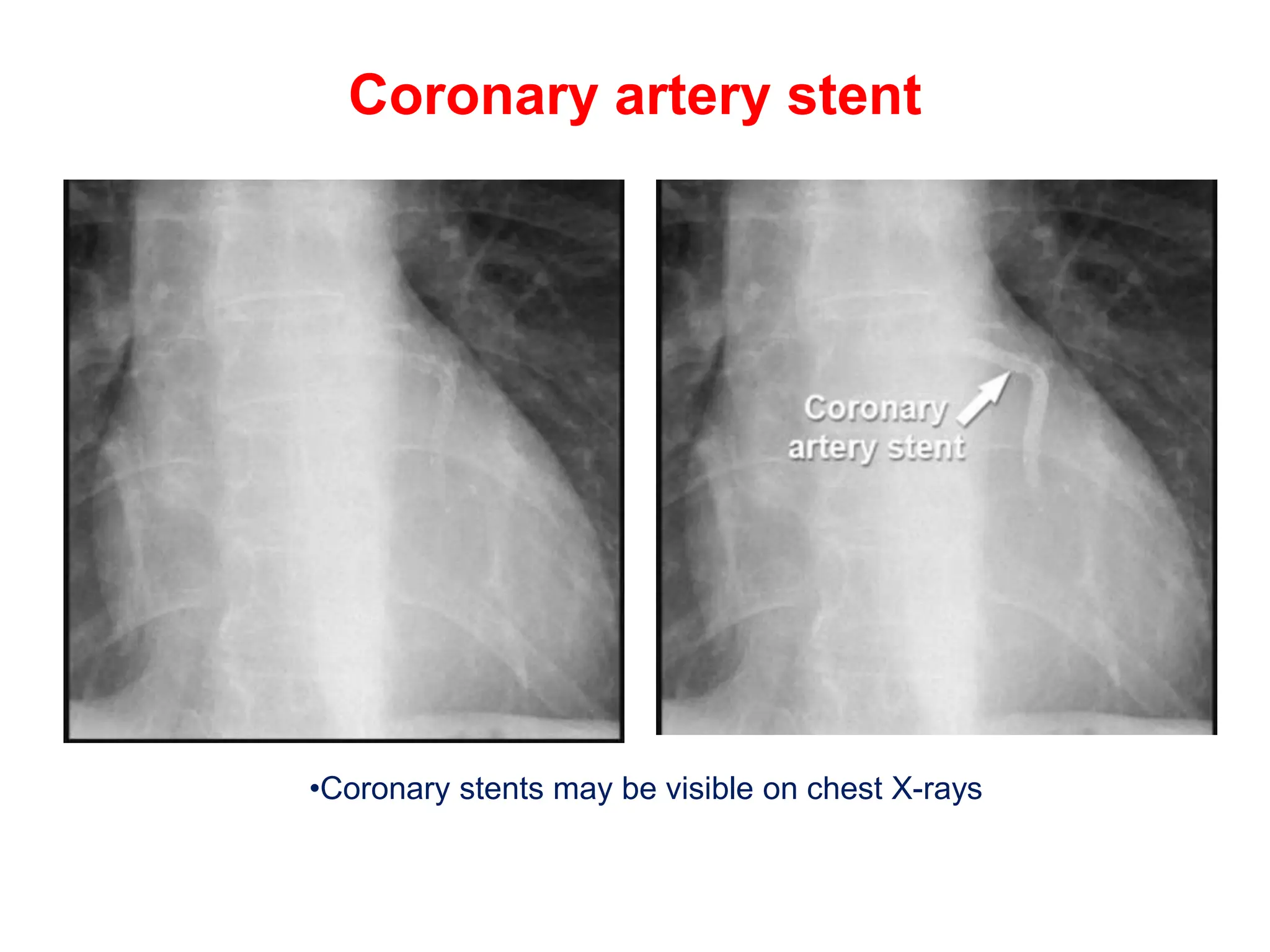 CHEST X-RAY CARDIAC DISEASE.........pptx
