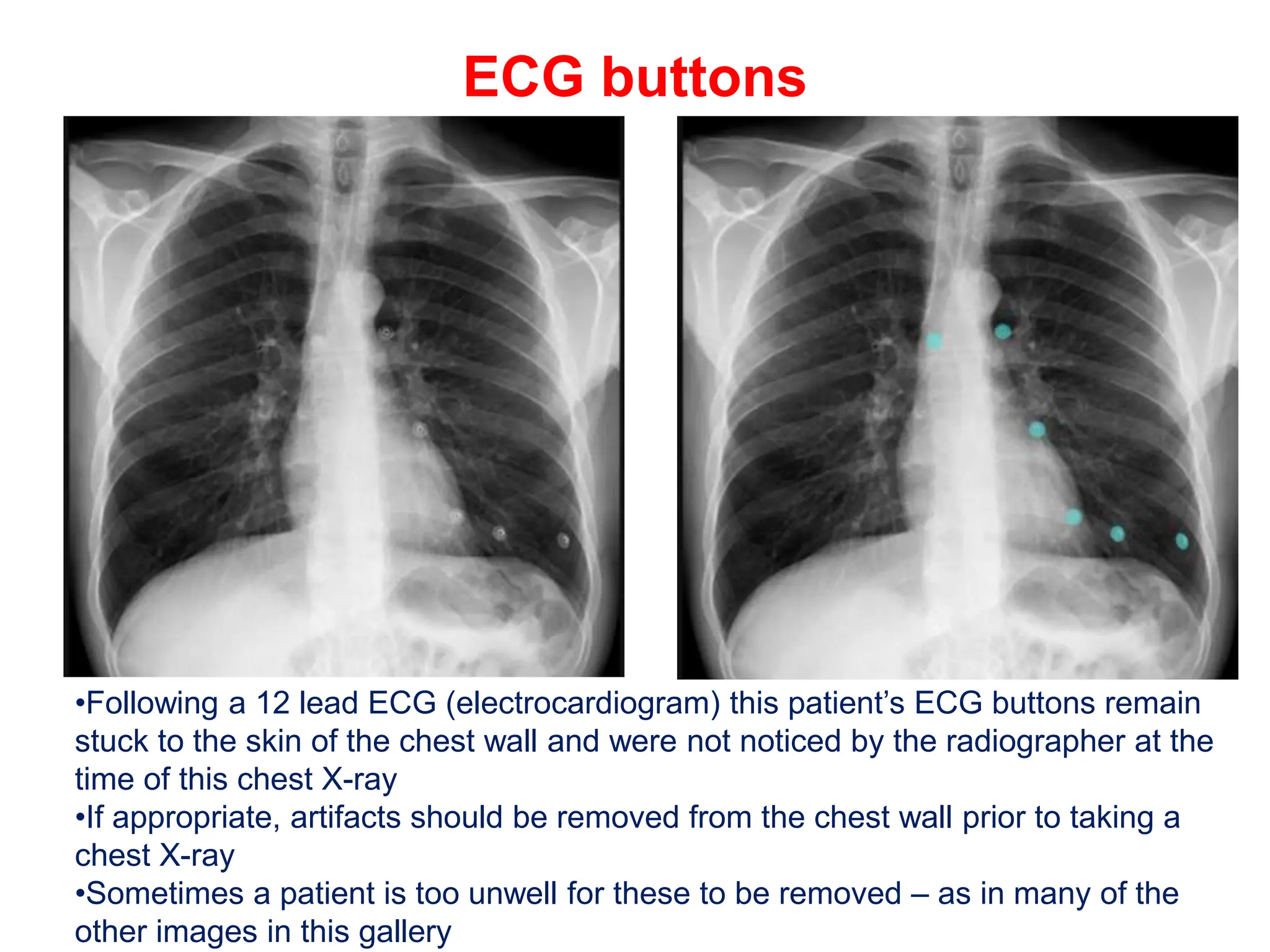 CHEST X-RAY CARDIAC DISEASE.........pptx
