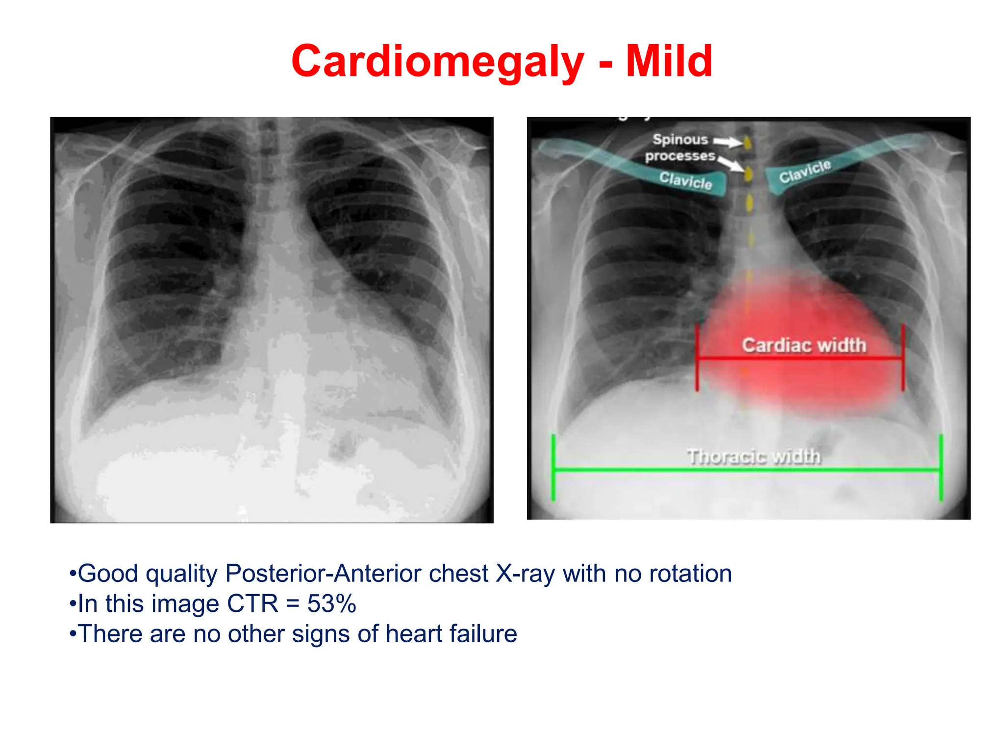 CHEST X-RAY CARDIAC DISEASE.........pptx