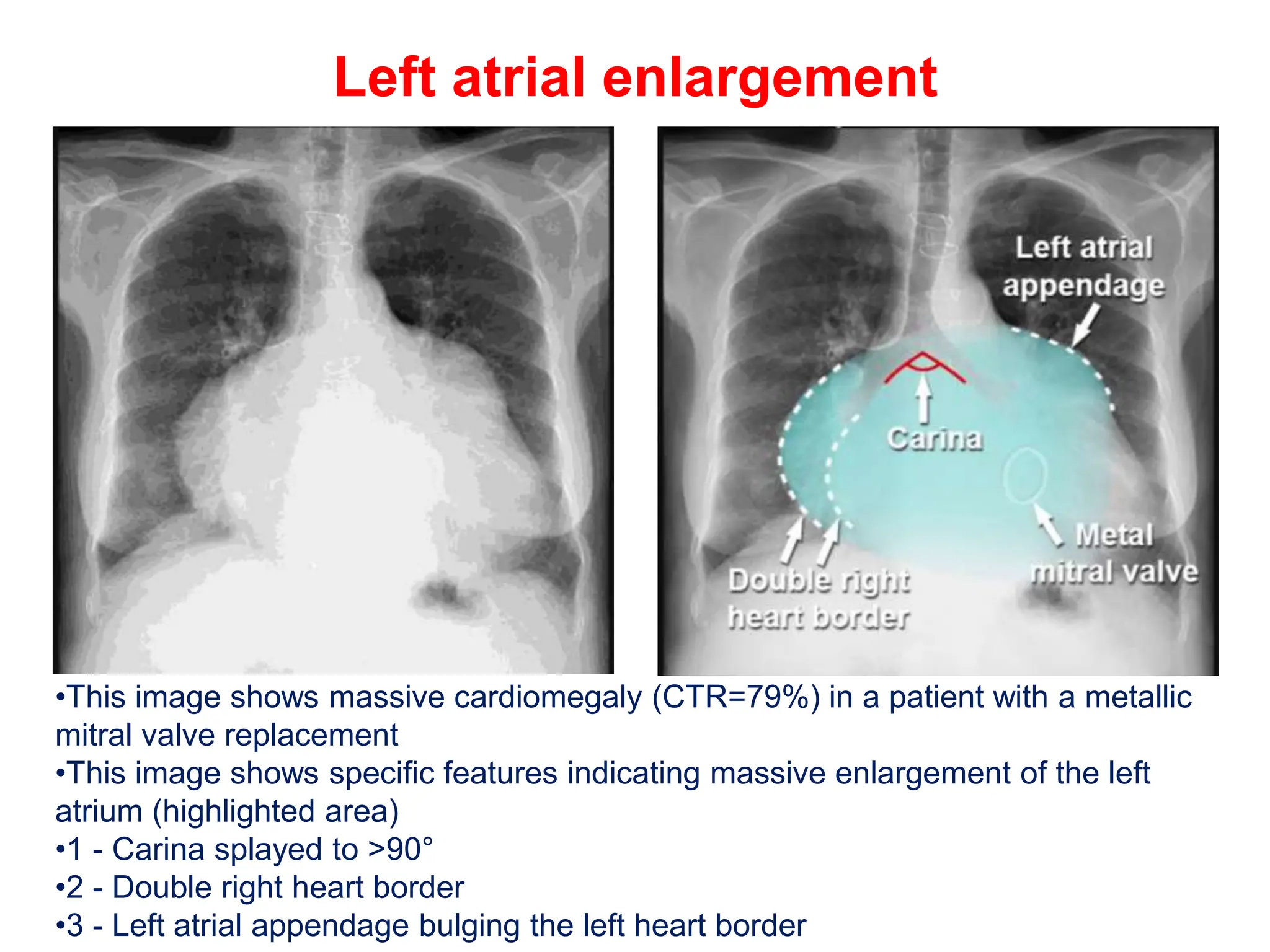 CHEST X-RAY CARDIAC DISEASE.........pptx