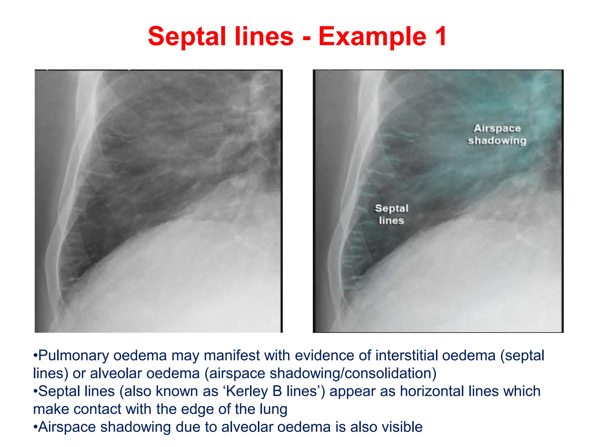 CHEST X-RAY CARDIAC DISEASE.........pptx